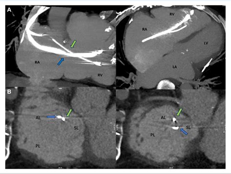 figure 4 from tricuspid valve leaflets lead interaction semantic scholar