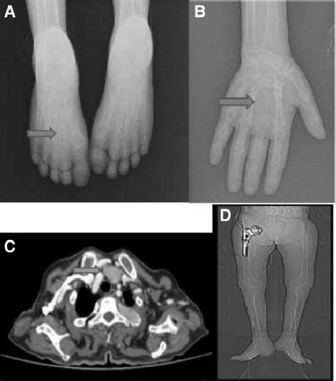 A Brown Tumor In The Metatarsal B Brown Tumor In The Metacarpal C