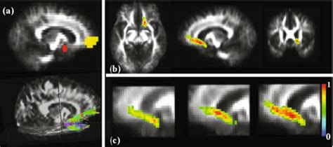 Uncinate Fasciculus Atlas Generated Using Group Wise And Download