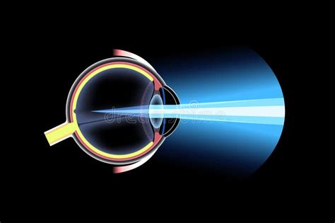 Nearsightedness Eye Disease Stock Vector Illustration Of Biology