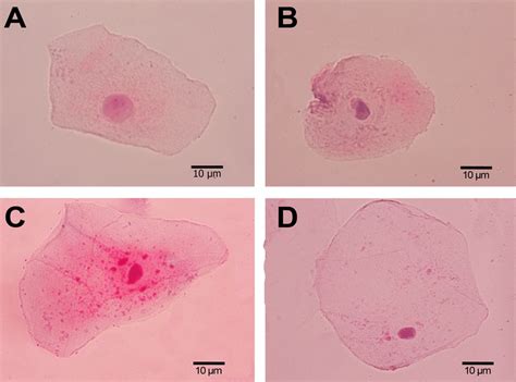 Exfoliated Mucosal Cells Normal Mucosal Cell A Condensed Chromatin