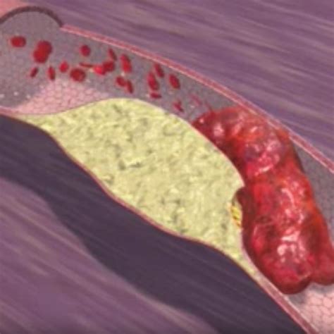 Coronary Thrombosis Removal Boston Scientific