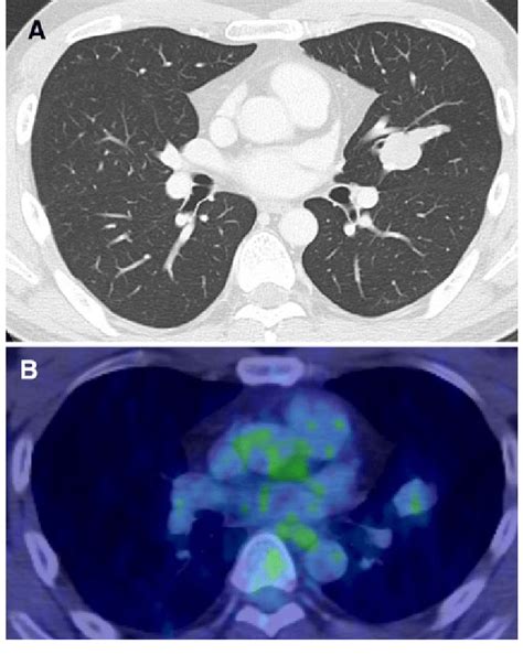 A Computed Tomography Shows A Mass With Well Defined Margins In The