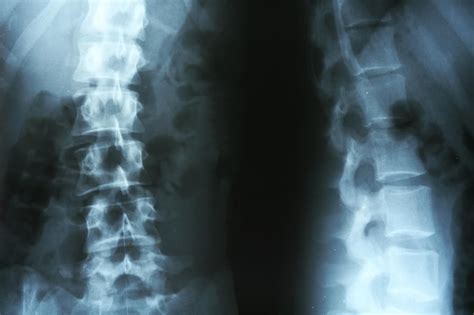 Raio X Do Close Up Humano Da Coluna Vertebral Foto Premium