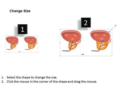 Benign Prostatic Hyperplasia BPH Medical Images For Powerpoint Template Presentation