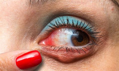 How To Get Rid Of Red Veins In Eyes Pure Optical