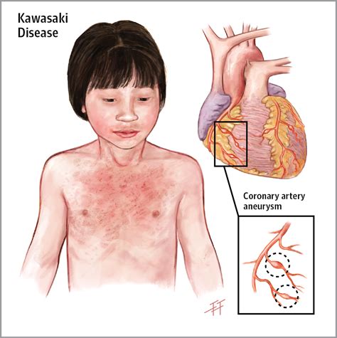 Sindrome De Kawasaki