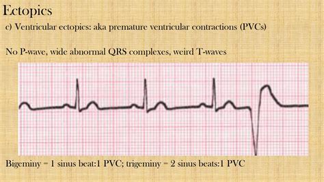 Lecture 5 Arrhythmias Part Ppt Download