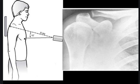 How To Do Clavicle X Ray