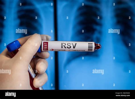 Blood Collection Tubes Respiratory Syncytial Virus RSV Test Positive Results Medical Concept