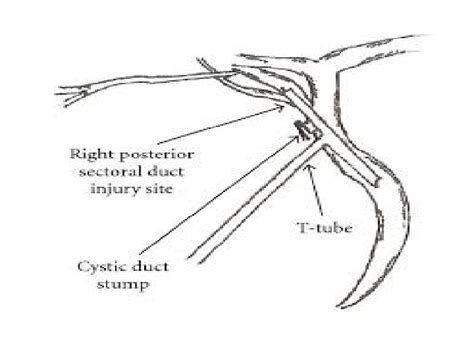 Cholangiography Or Cholangiogram Anatomy Of Biliary System Cholangiography
