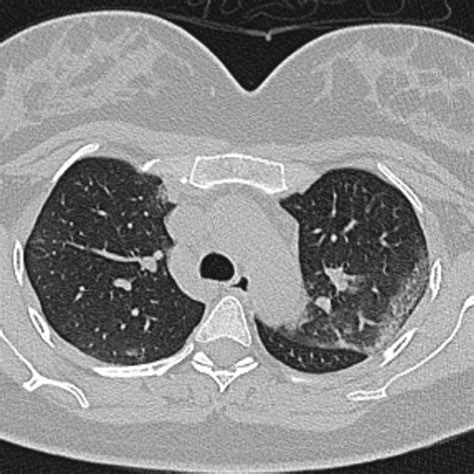 Chest Computed Tomography A Coronal Section Through The Lung Lung
