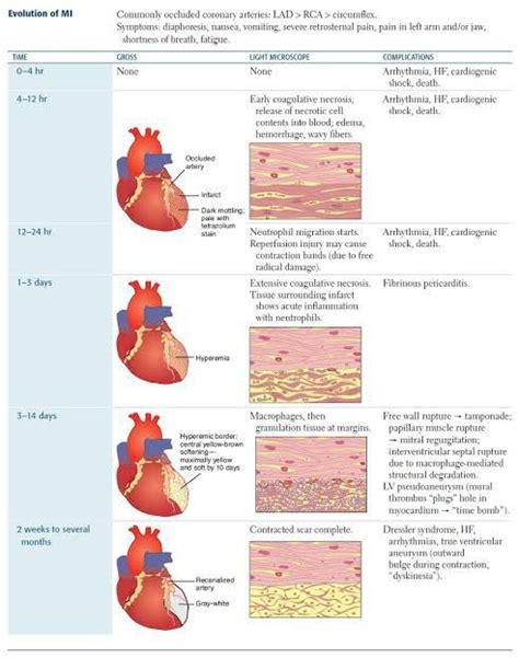 Evolution Of Myocardial Infarction Medizzy