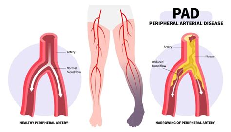 Peripheral Artery Disease Vs Peripheral Vascular Disease