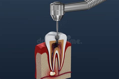 Root Canal Treatment Process Illustration Stock Illustration