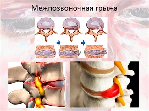 Грыжа поясничного отдела позвоночника - лечение или операция?