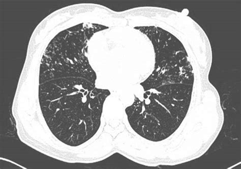 High Resolution Computed Tomography Of The Thorax Showing Tree In Bud Download Scientific