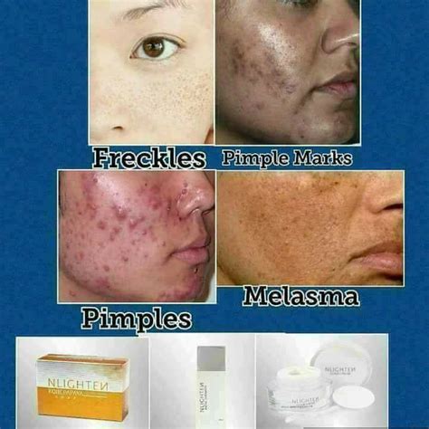 Ntrep Lehman Problem On ️freckles ️pimplles