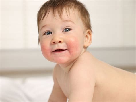 The Facts On Fifth Disease Archives Urgent Care Of Fairhope