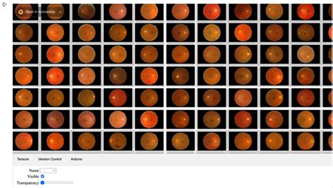Efficientnet For Diabetic Retinopathy Healthcare Ml Models