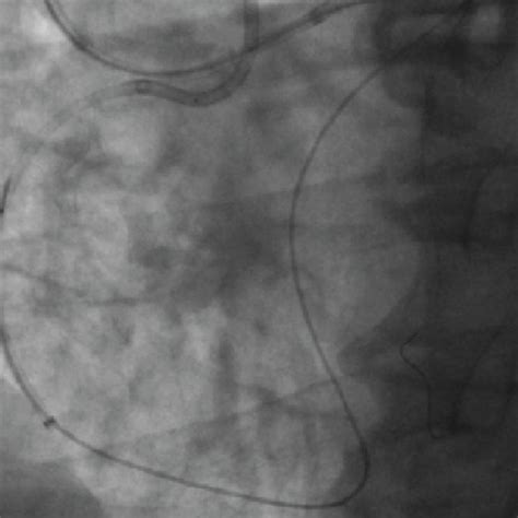 Rca Bifurcation Cto Pci A Corsair Catheter In The Right Plv Placed