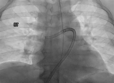 Computer Assisted Vacuum Thrombectomy Cavt The Future Of Thrombus Removal Cardiac