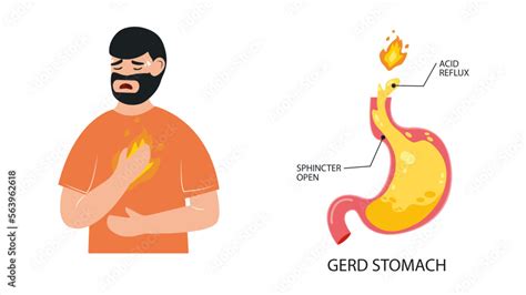 Man Suffering From Gerd Symptom With Acid Reflux Because Of Sphincter