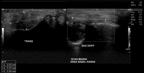 Nasofrontal Encephalocele A Case Report With Literature And Management