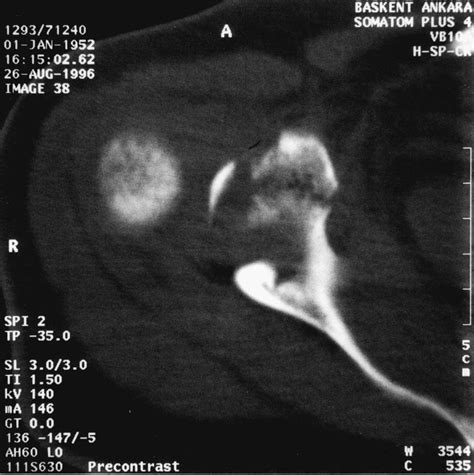 Malignant Mixed Mesodermal Tumor Arising In A Benign Cystic Teratoma