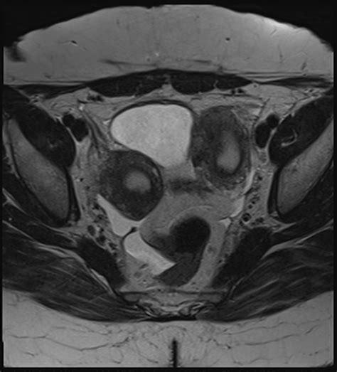 Filebicornuate Unicollis Uterus Radiopaedia 79468 92593 Axial T2 10
