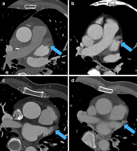 Representative Examples Of Left Atrial Appendage Thrombus A B And