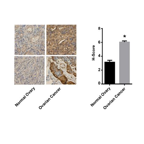 Ovarian Cancer Has Significantly Higher Nat8l Protein Levels Compared