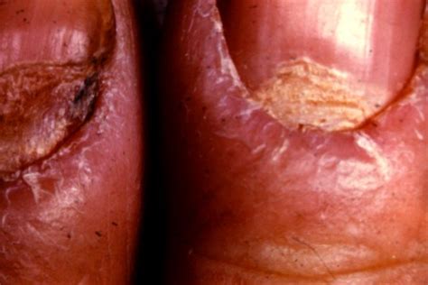 Paronychiae Paronychiae Dr Robert J Schoenfeld Wayne State