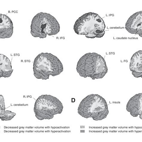 Multimodal Meta Analysis Of Structural And Functional Abnormalities In Download Scientific