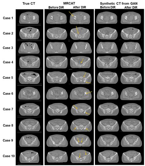 comparing true ct images first row to mrcat images second row and