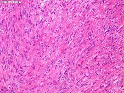 Fibrosarcoma Of Heart