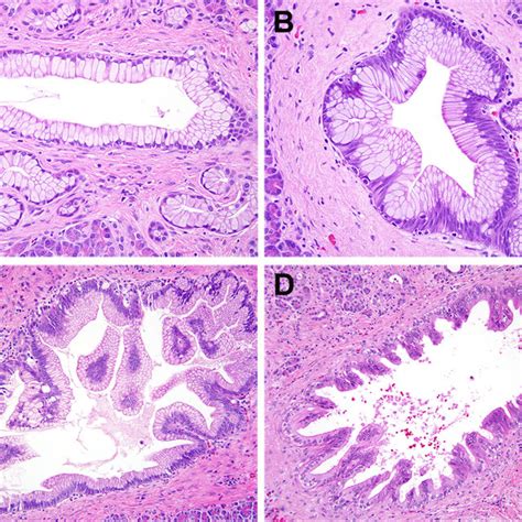 Ipmn Gross Features Grossly Ipmns Are Classified Based On Their Level