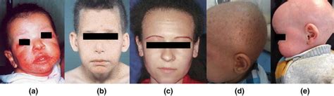 Clinical Manifestations Of Ichthyosis Syndromes With Prominent Hair