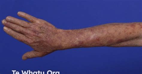 Secondary Syphilis Image