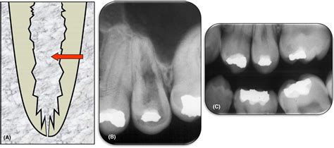 Tooth Resorption—part 2 A Clinical Classification Abbott 2022