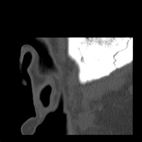 Normal Temporal Bone Ct With Annotated Images Radiopaedia 84293 99584