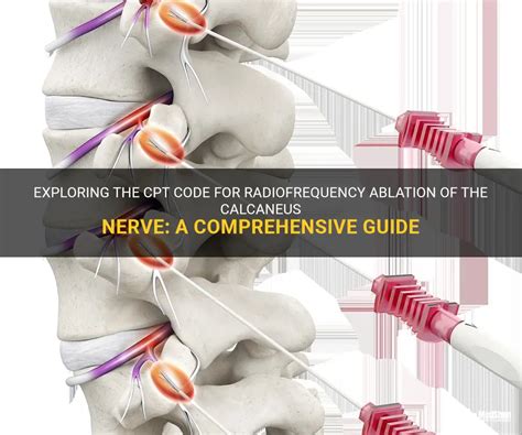 Exploring The Cpt Code For Radiofrequency Ablation Of The Calcaneus Nerve A Comprehensive Guide