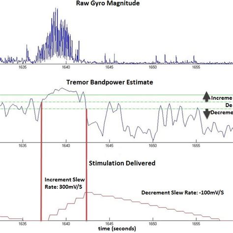example of bilateral adaptive dbs adbs based on lfp beta oscillation