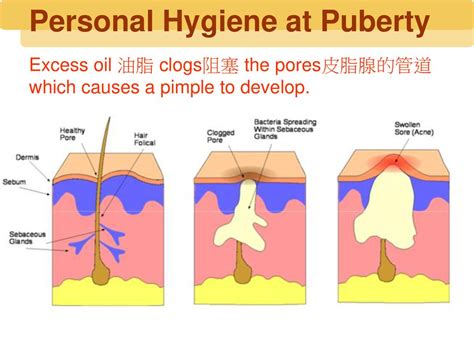 What should we do if we have pimples 暗瘡and body odour體臭 ppt download