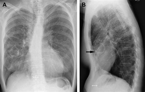 Bronchiectasis Thoracic Surgery Clinics