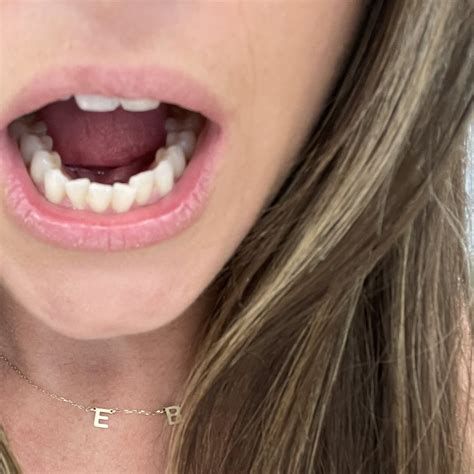 Byte Teeth Aligner Trial Before And After Review Just Simply Mom