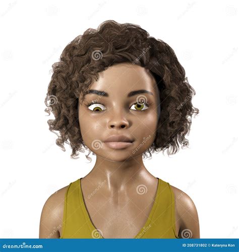 Strabismus Eyes Deviation Illustration Stock Illustration