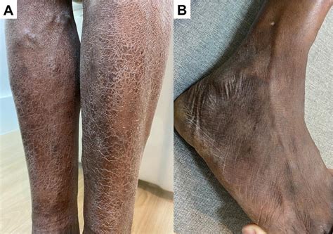 A Multiple Ichthyosis In Islets In The Lower Limbs B Linear