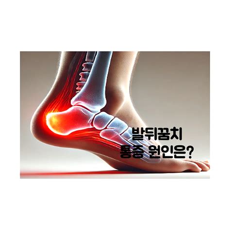 발바닥 뒤꿈치가 아파요 발바닥 뒤꿈치 통증 원인 증상부터 치료와 예방 방법까지