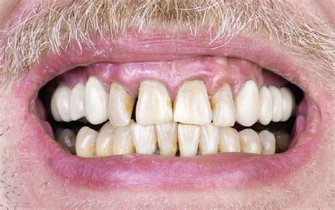 Smoking And Gum Disease